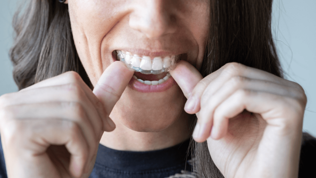 What’s the big deal about Invisalign? | Myofunctional Therapy and ...